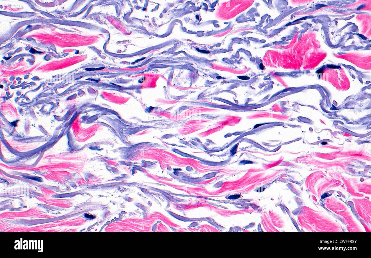 Solar elastosis, light micrograph Stock Photo - Alamy