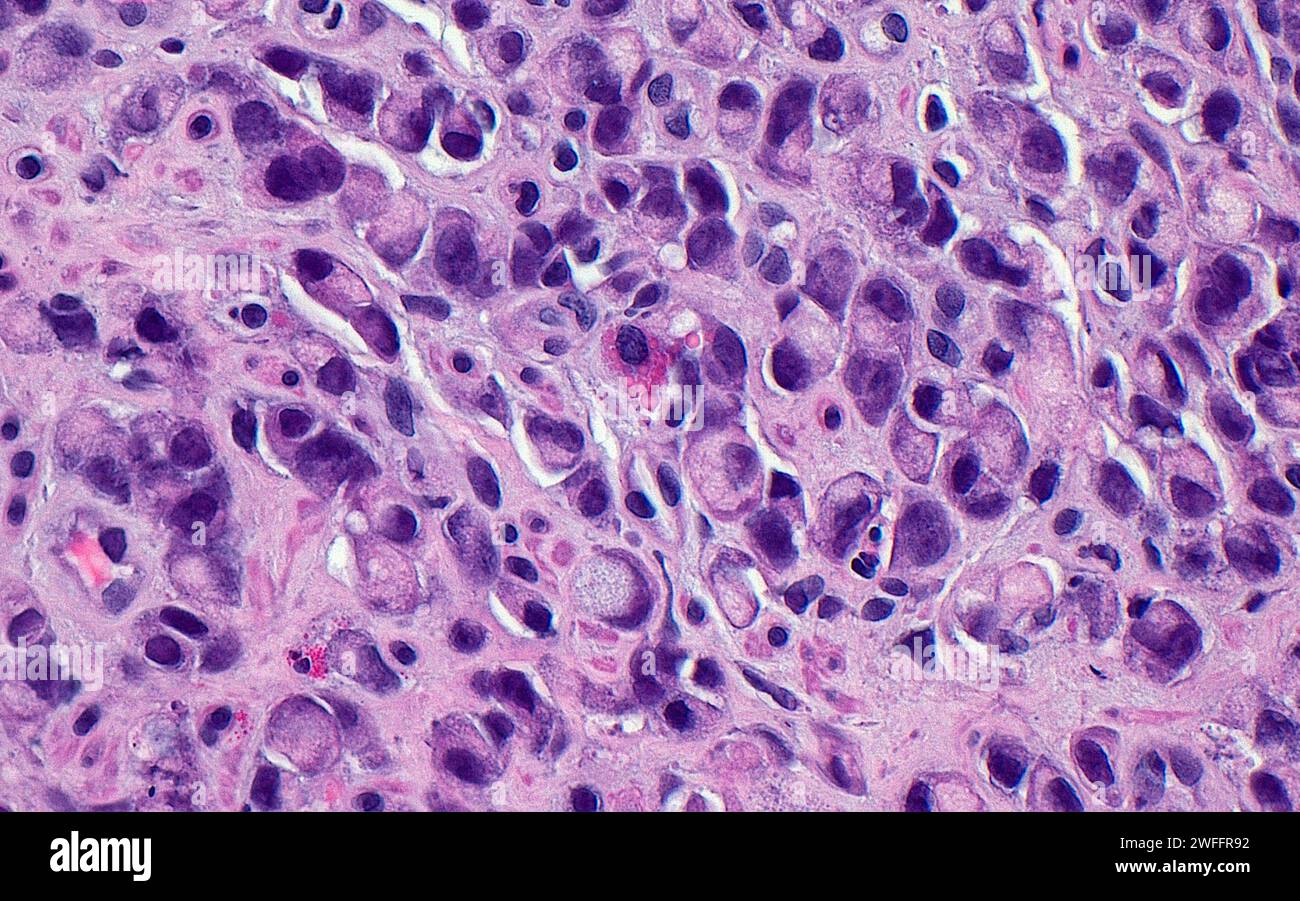 Signet ring cell cancer, light micrograph Stock Photo - Alamy