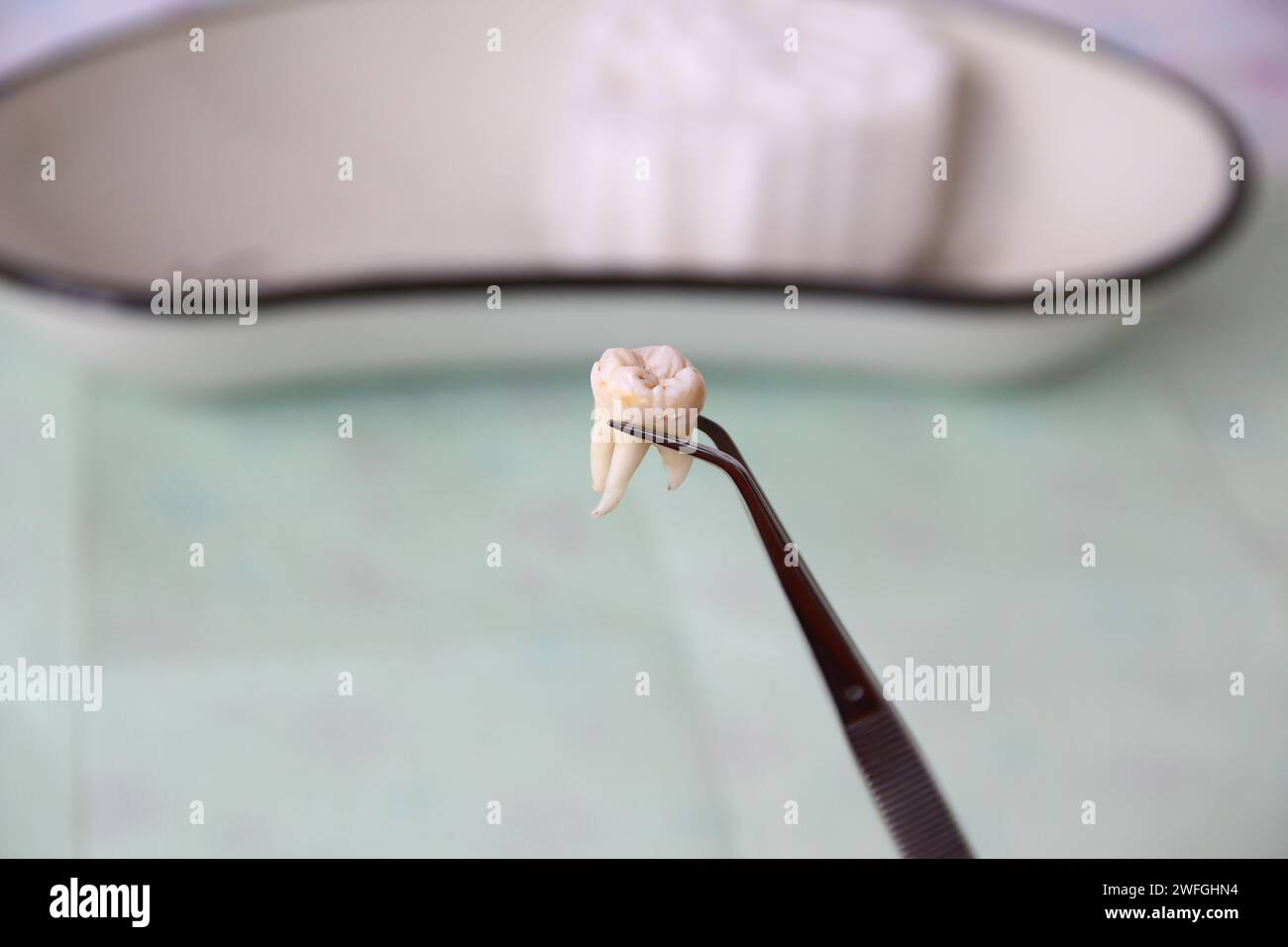 Extracted tooth hi-res stock photography and images - Alamy