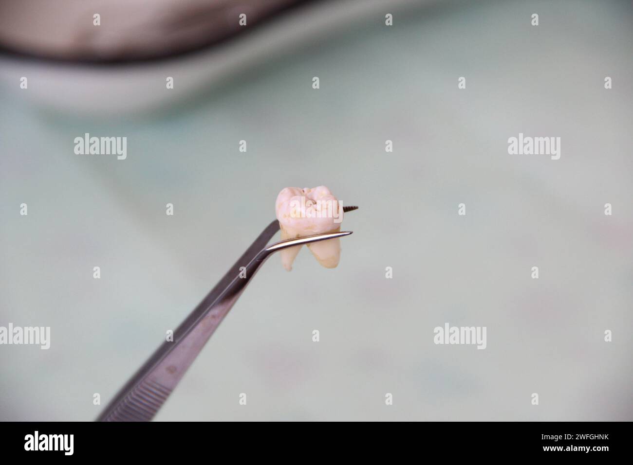 Extracted tooth in tweezers against the background of the dental tray ...