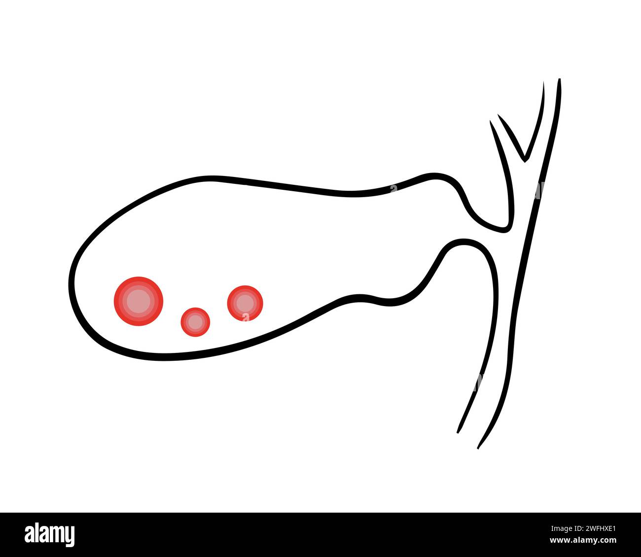 Gall Bladder Stones Stock Vector Images Alamy