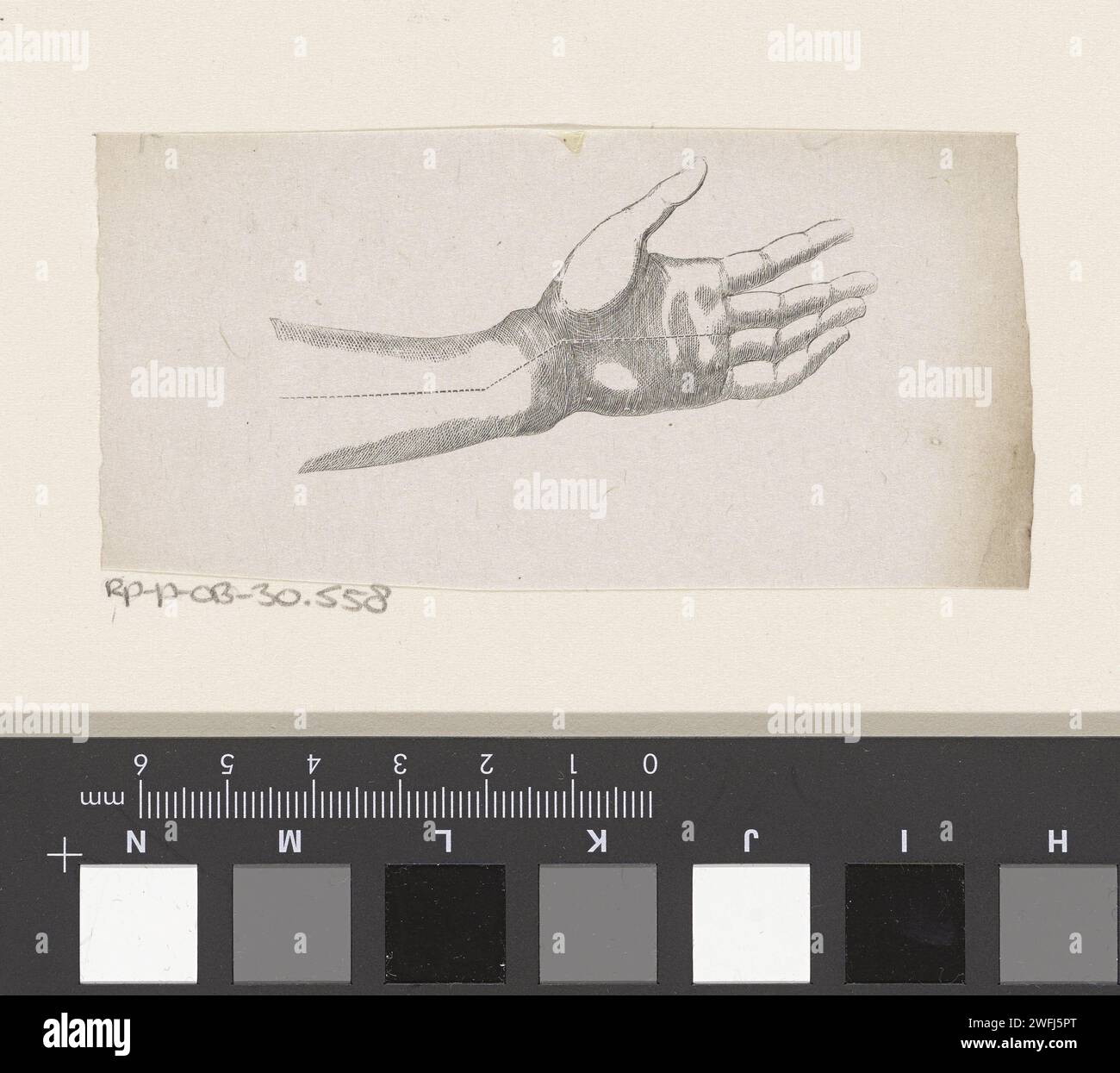 Human wrist with a fracture in the bone, Isaac Weissenbruch, 1836 ...