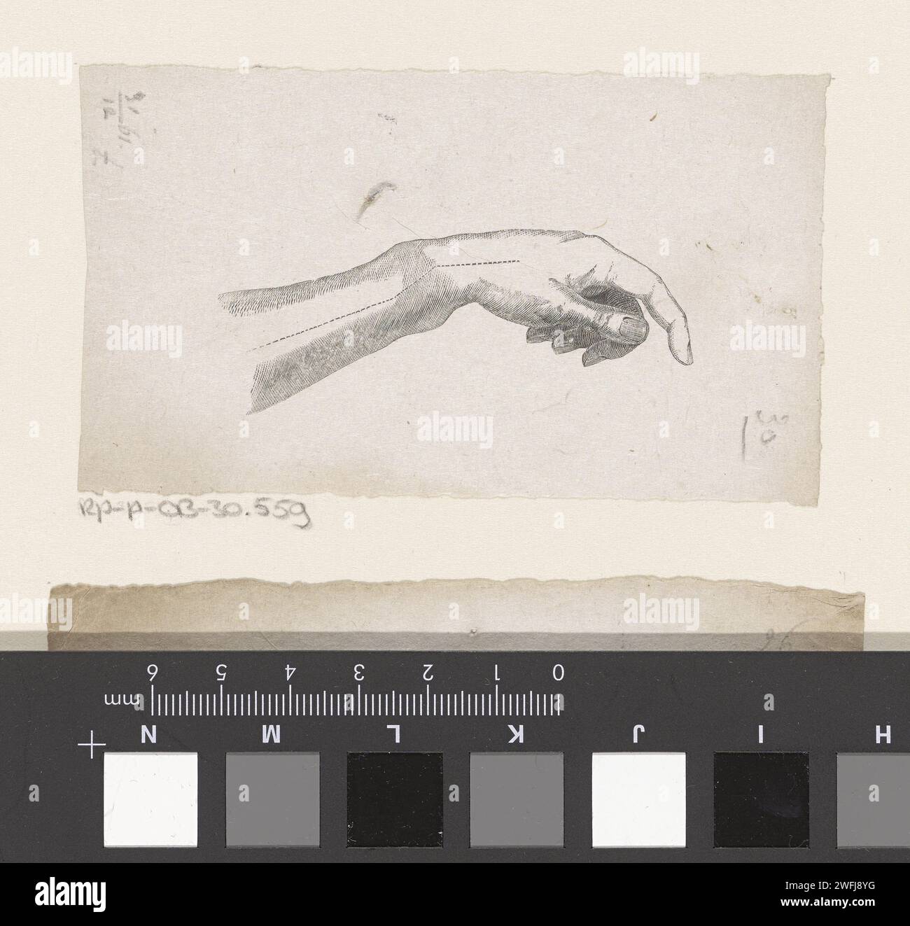 Human wrist with a fracture in the bone, Isaac Weissenbruch, 1836 ...