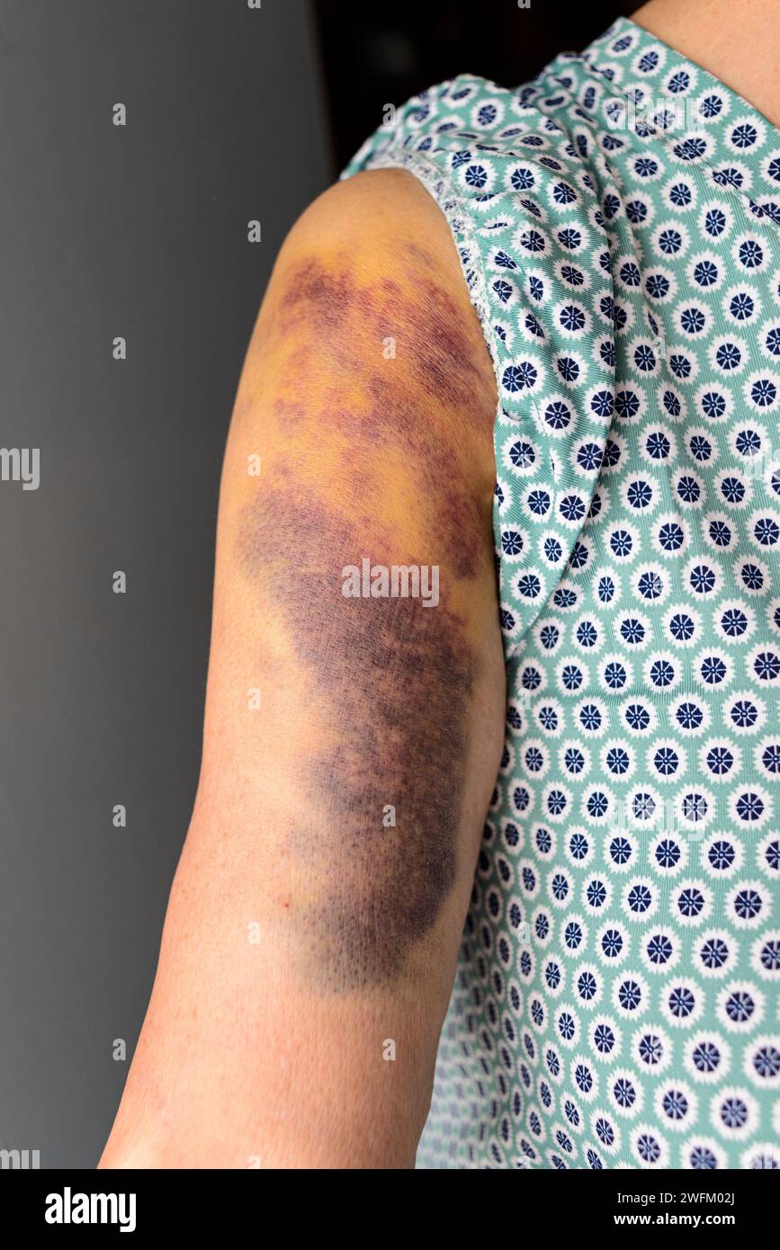 Bruised arm hi-res stock photography and images - Alamy