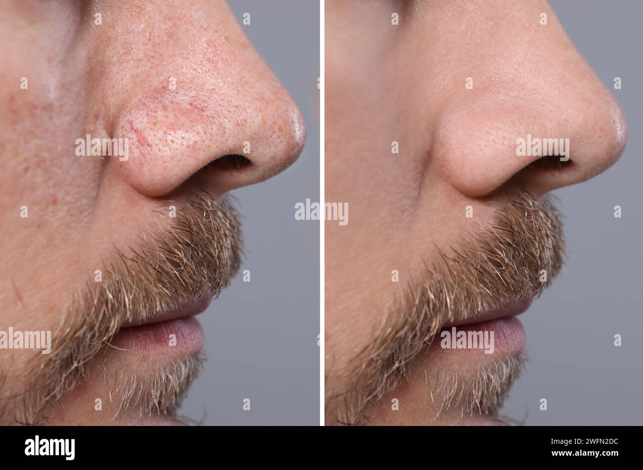 Blackhead treatment, before and after. Collage with photos of man on ...