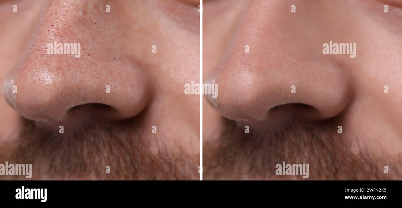 Blackhead treatment, before and after. Collage with photos of man ...