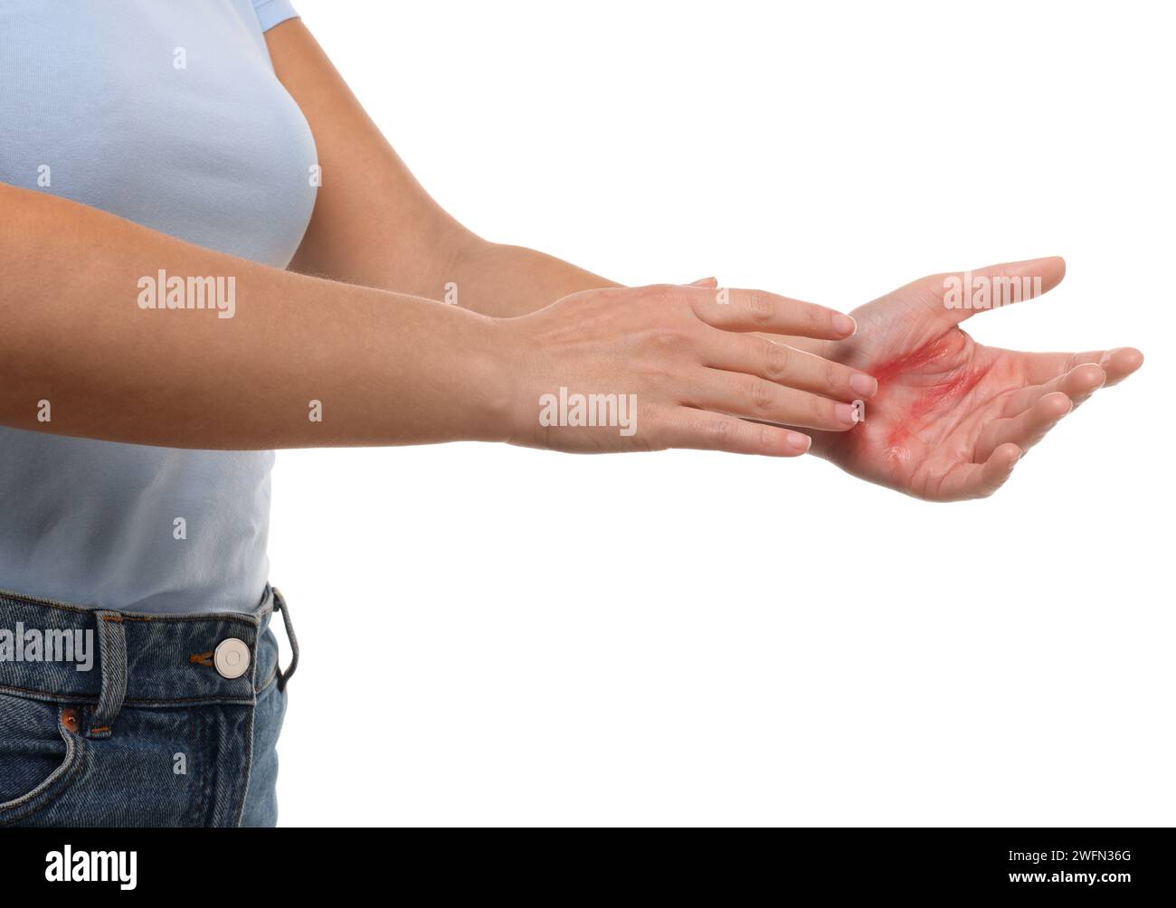 Burn mark on hand hi-res stock photography and images - Alamy