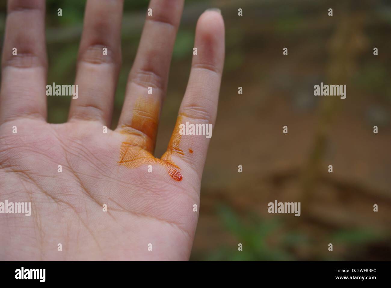 Stock photo of sores forming scabs on hands and arms. Injury occurred ...