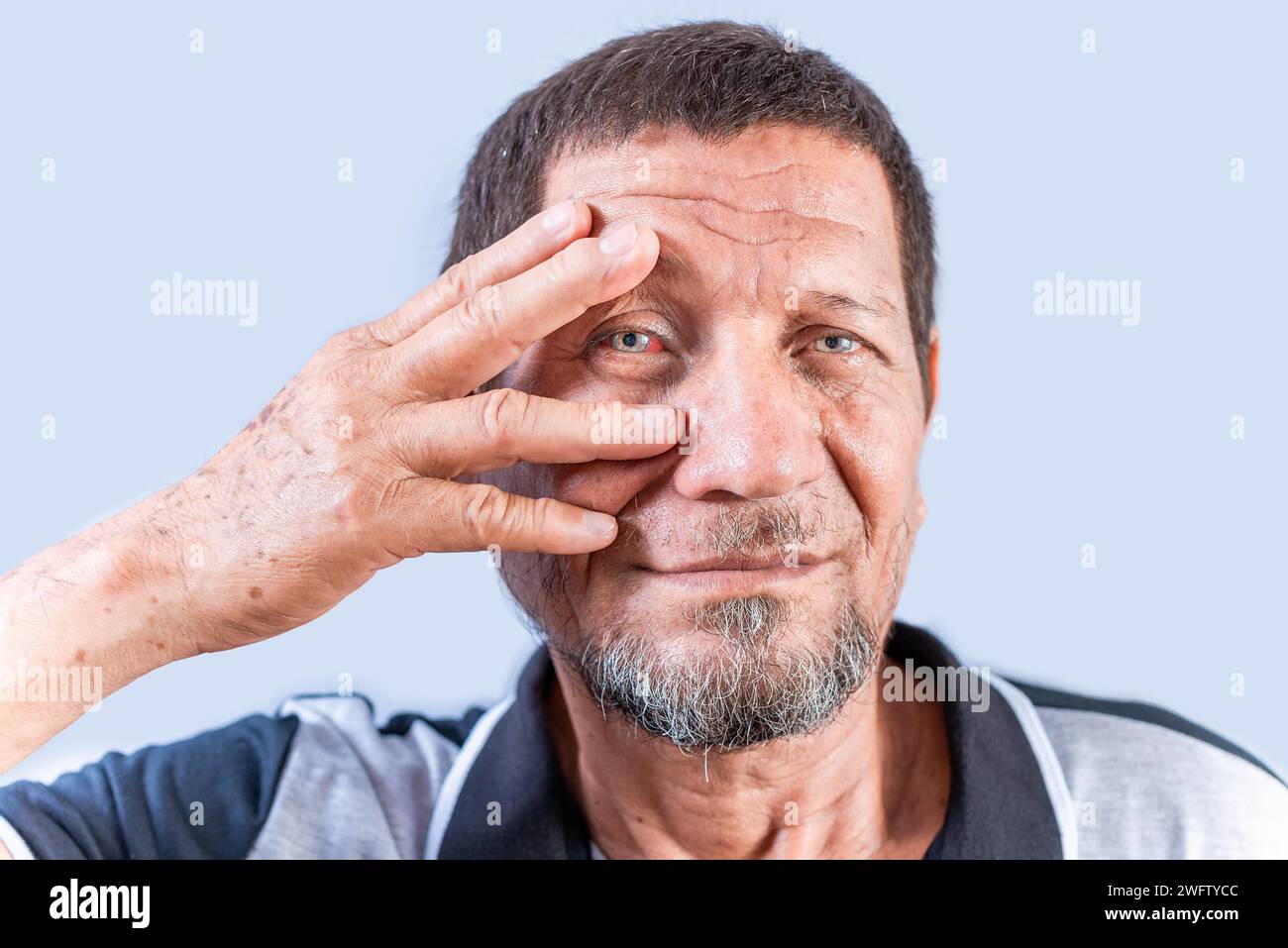 Allergic conjunctivitis hi-res stock photography and images - Alamy