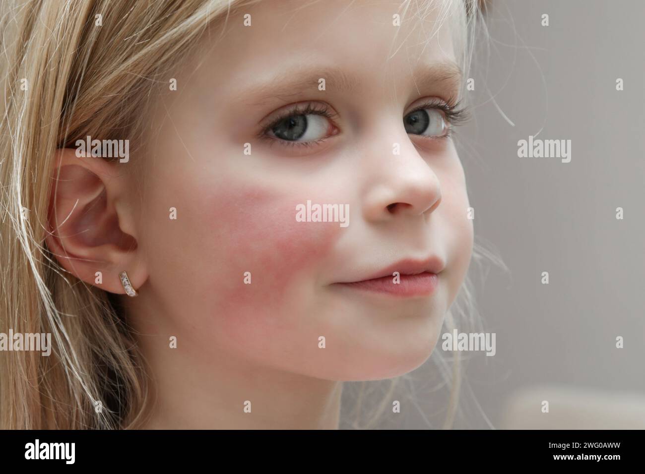 Redness on child's cheeks caused by eczema, dry skin or allergy Stock ...