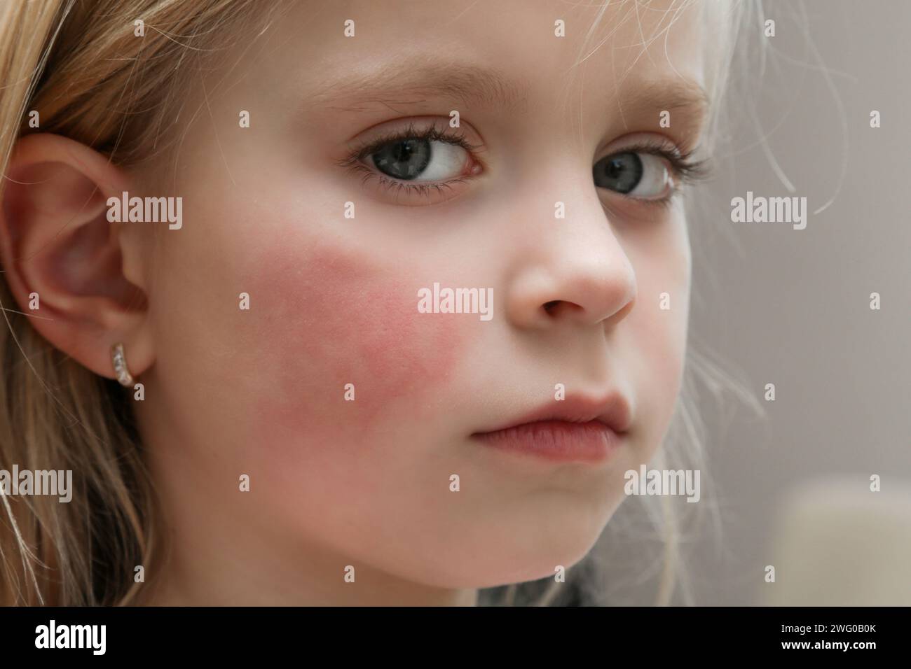 Redness on child's cheeks caused by eczema, dry skin or allergy Stock ...