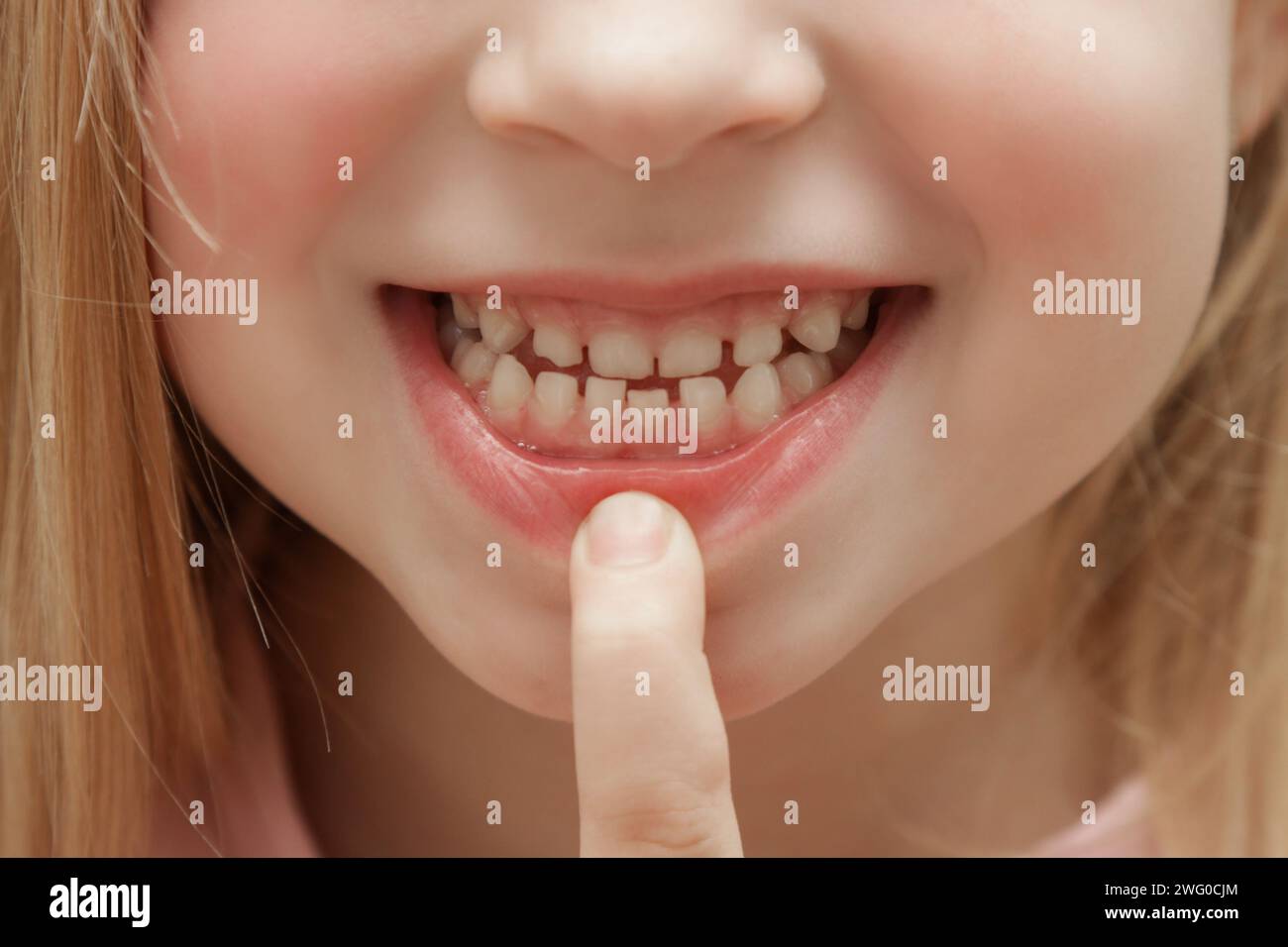 Cute preschool girl showing a loose primary (baby) tooth Stock Photo ...