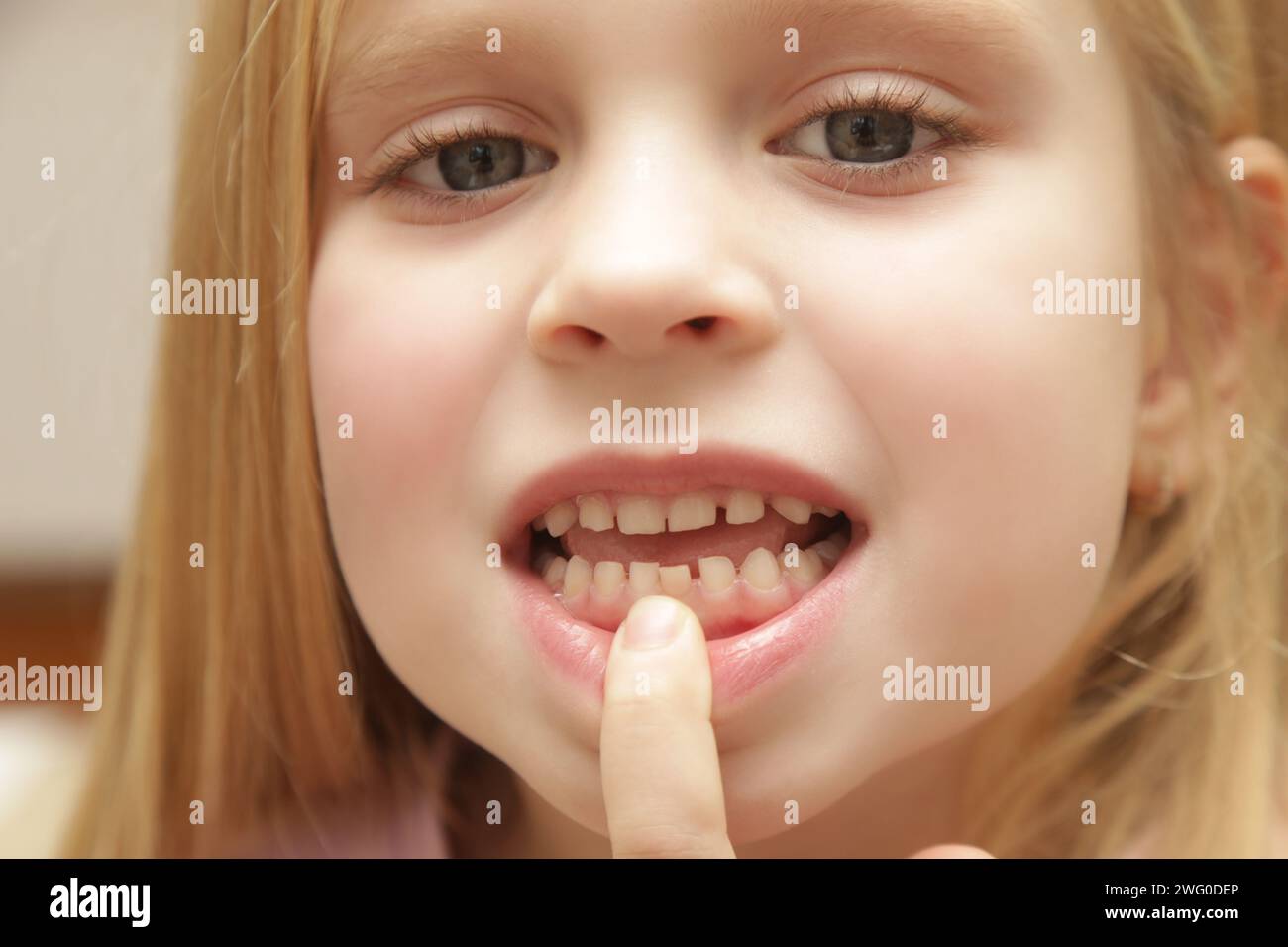 Cute preschool girl showing a loose primary (baby) tooth Stock Photo ...