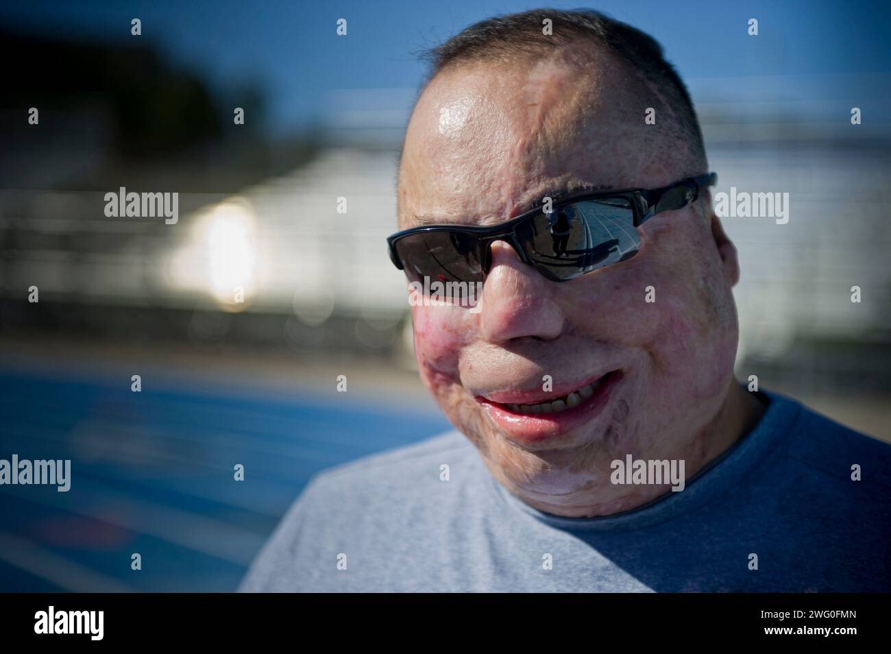 Burnt scar hi-res stock photography and images - Alamy