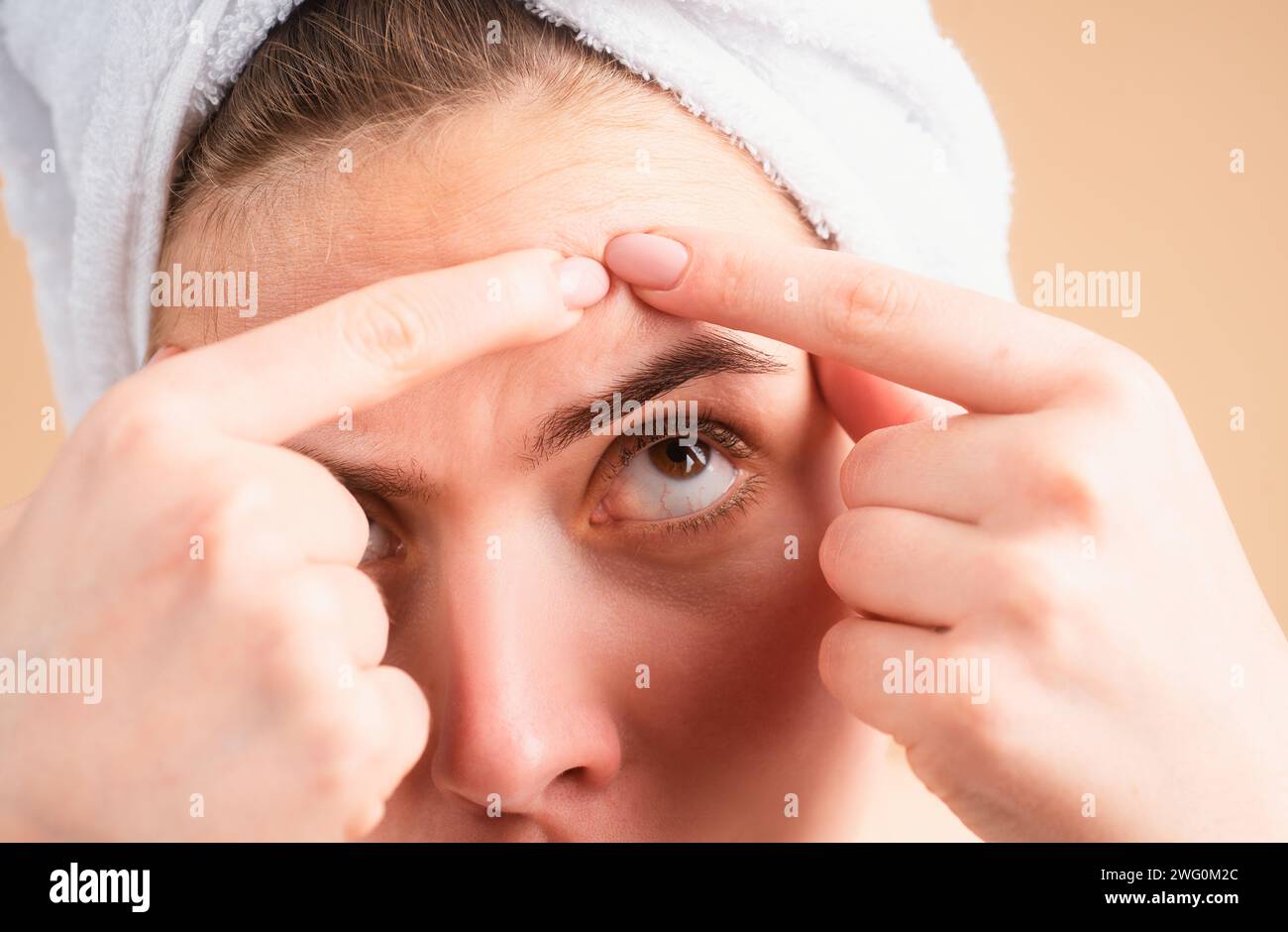 Close up squeezing pimples on her face. Acne blemish spots skin on ...