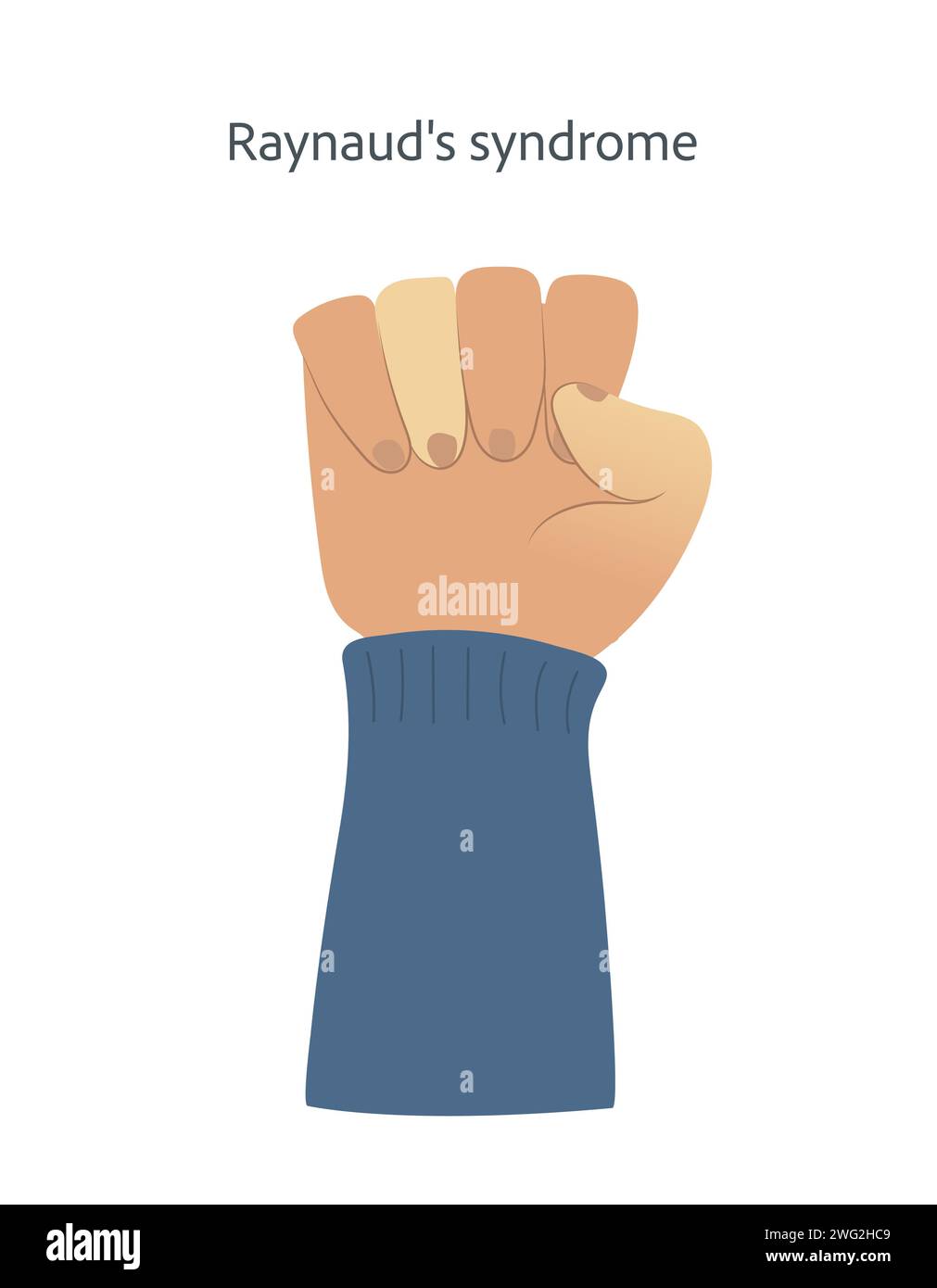 A hand with Raynaud's syndrome symptoms on fingertips. Peripheral ...