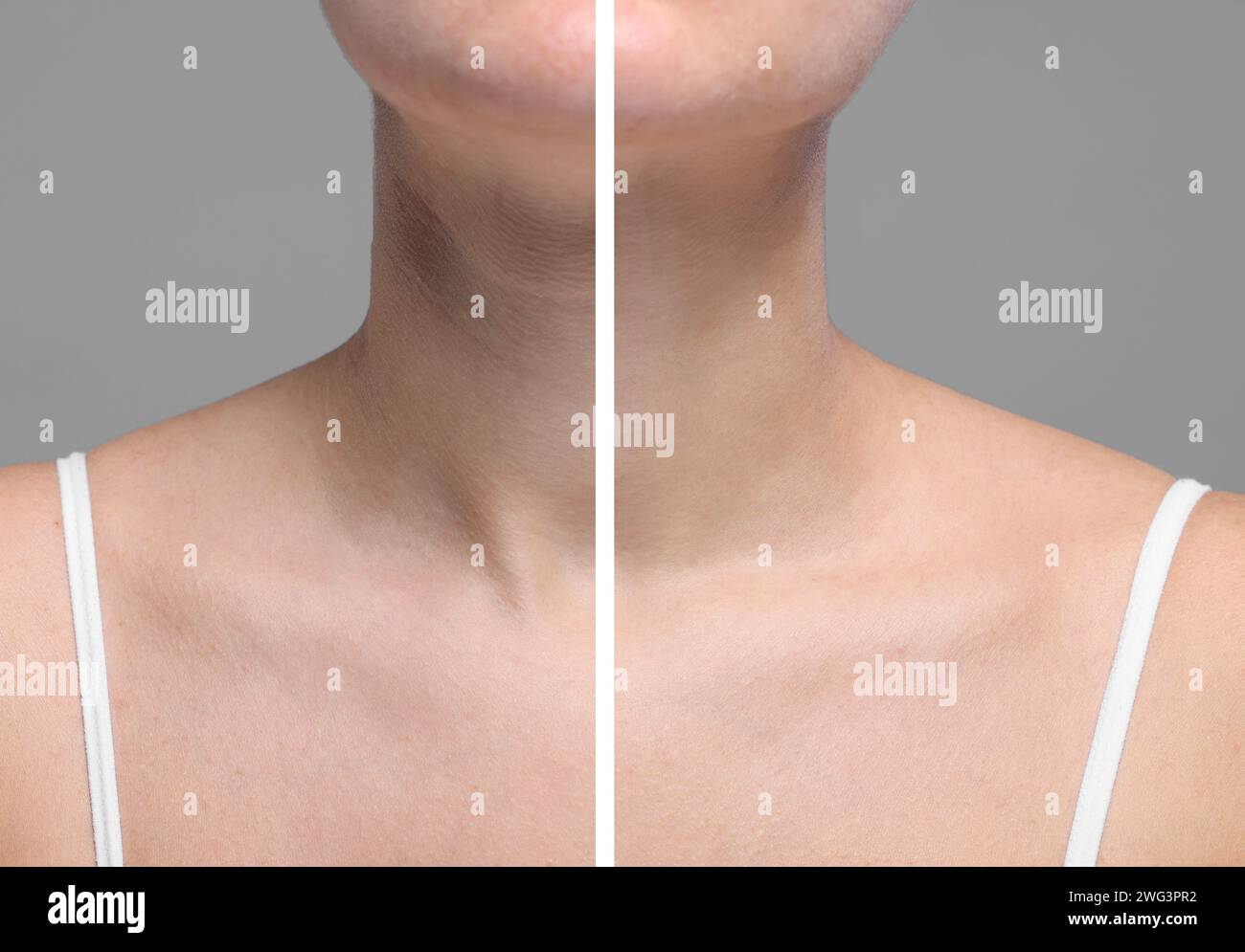 Aging skin changes. Woman showing neck before and after rejuvenation ...