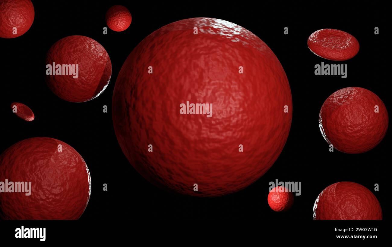 3d rendering of spherocyte, it is a red blood cell (RBC) that is ...