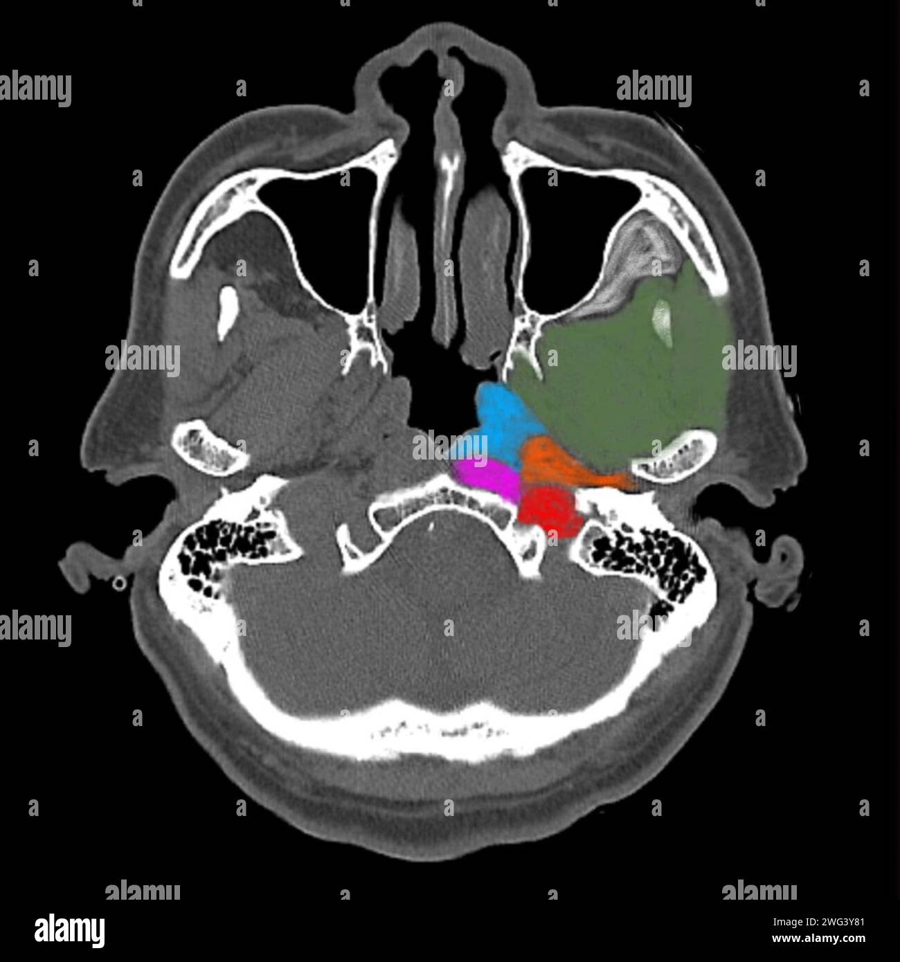 Axial Head Computed Tomography Ct Scan Showing The Anatomy Of The Deep Neck Space The Green