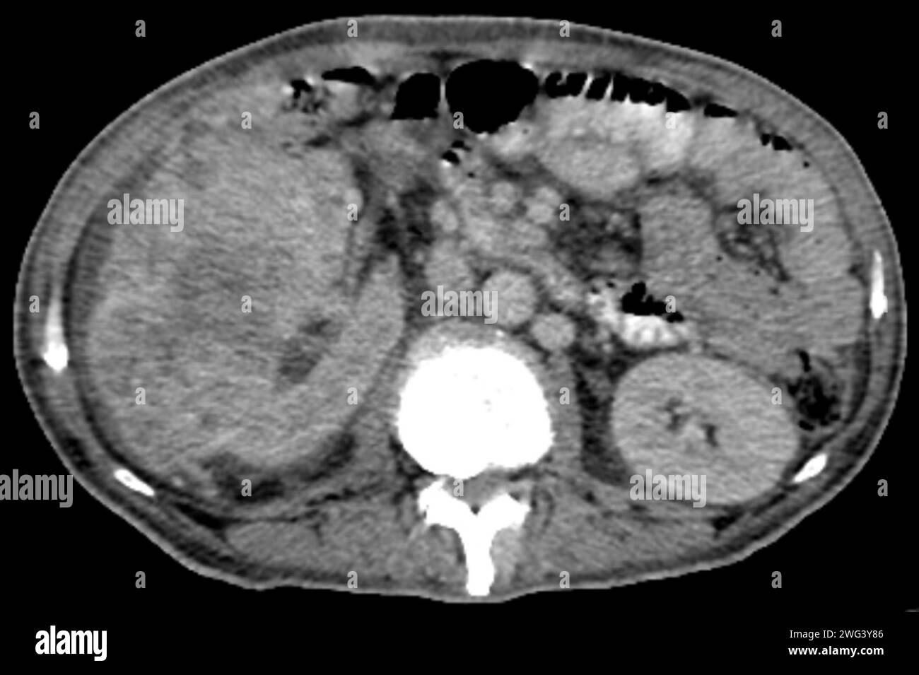 Abdominal ct scan abdomen hi-res stock photography and images - Alamy