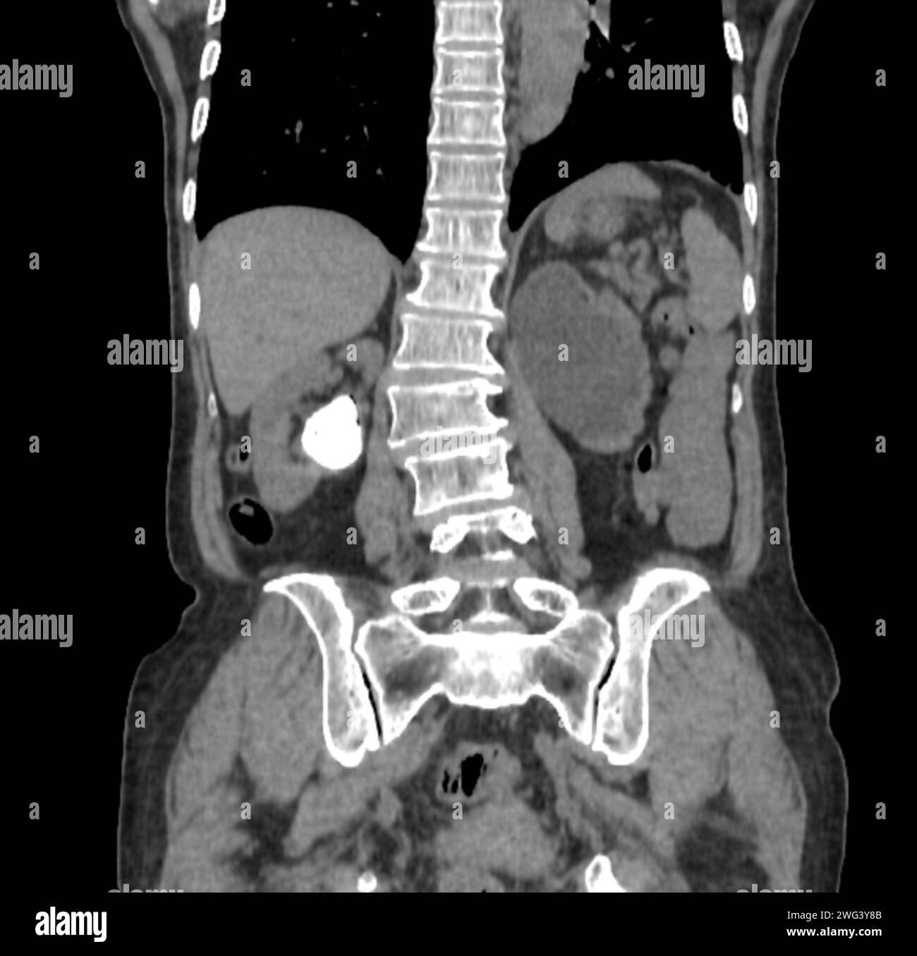 Coronal abdominal computed tomography (CT) scan showing a hyperdense ...