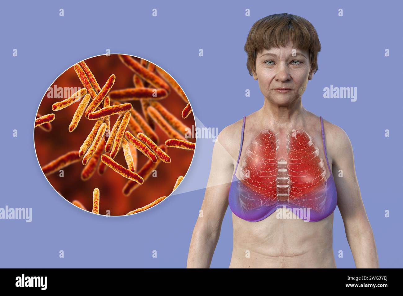Woman with lung miliary tuberculosis, illustration Stock Photo - Alamy