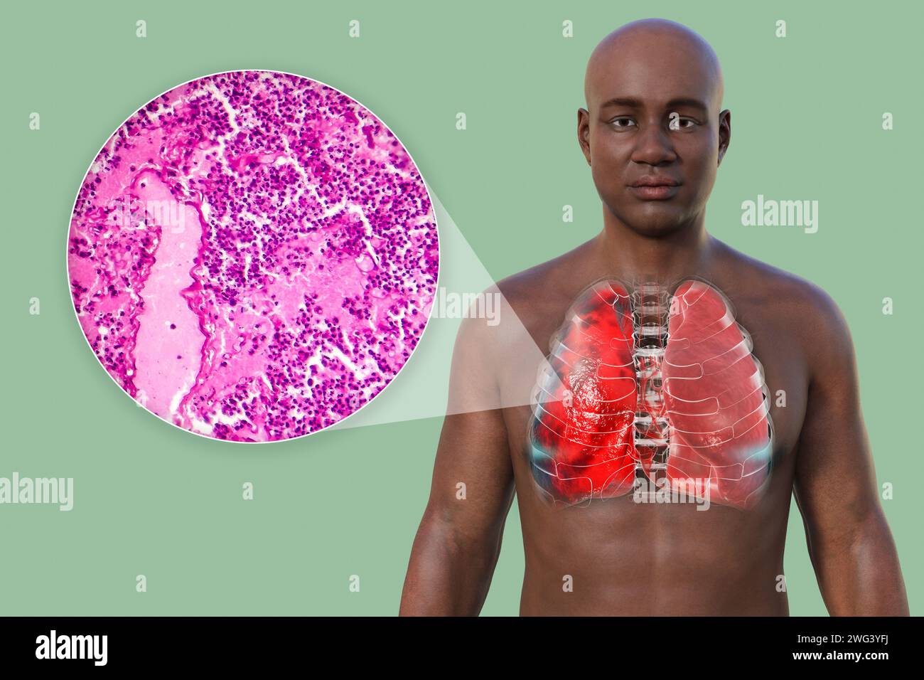 Man with lungs affected by pneumonia, illustration Stock Photo - Alamy