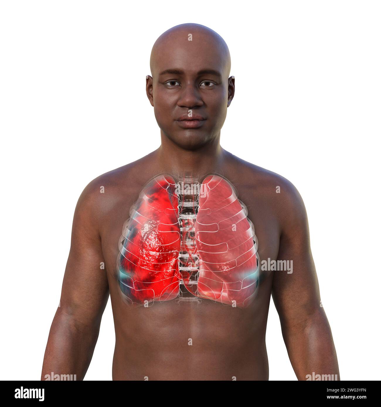 Pneumonia hi-res stock photography and images - Alamy