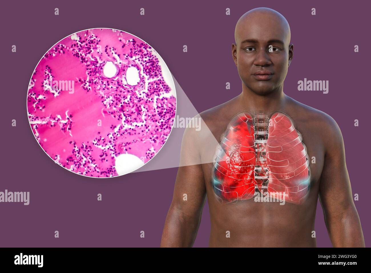 Man with lungs affected by pneumonia, illustration Stock Photo - Alamy