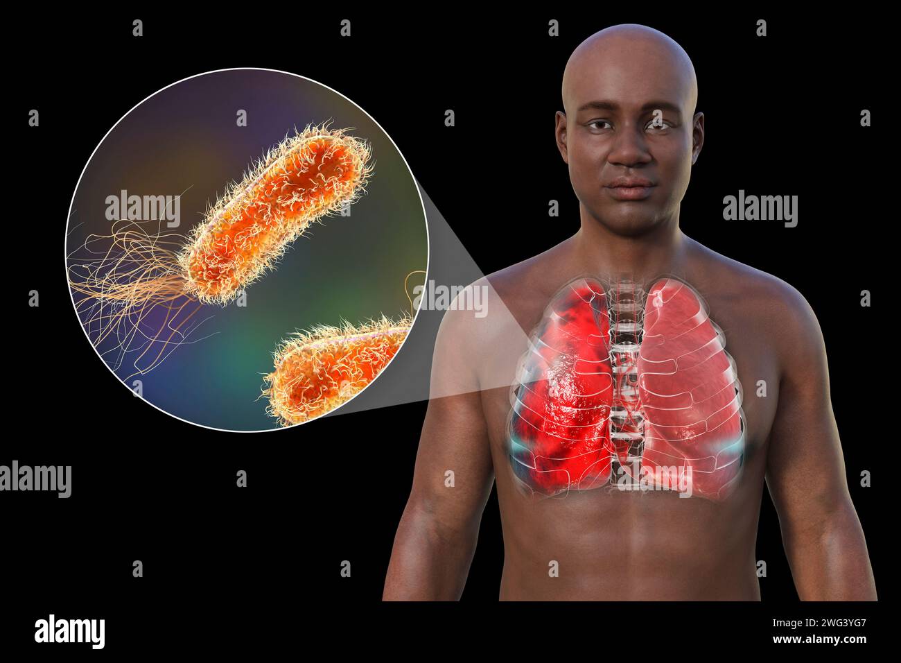 Man with lungs affected by pneumonia, illustration Stock Photo - Alamy