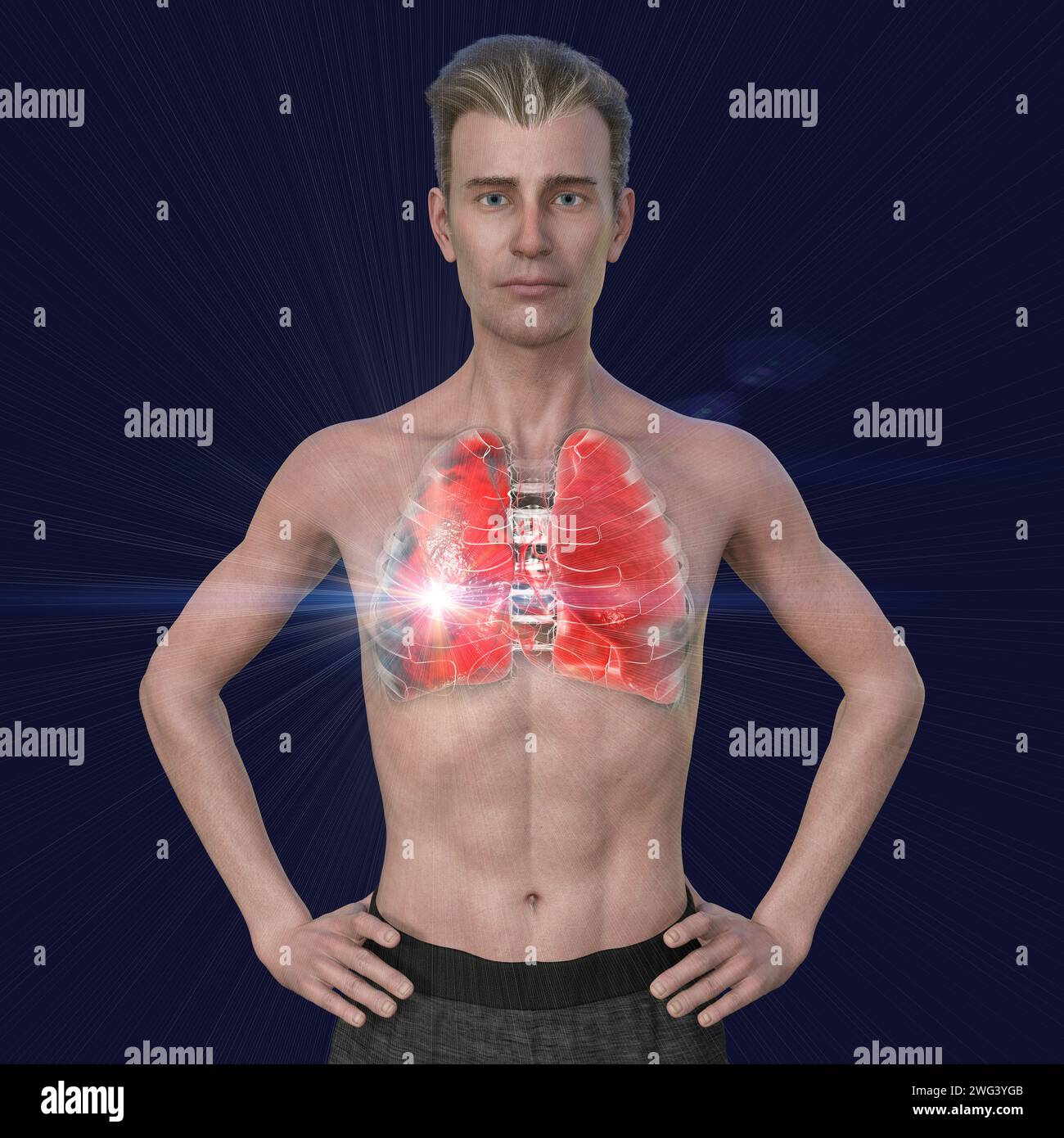 Man with lungs affected by pneumonia, illustration Stock Photo - Alamy