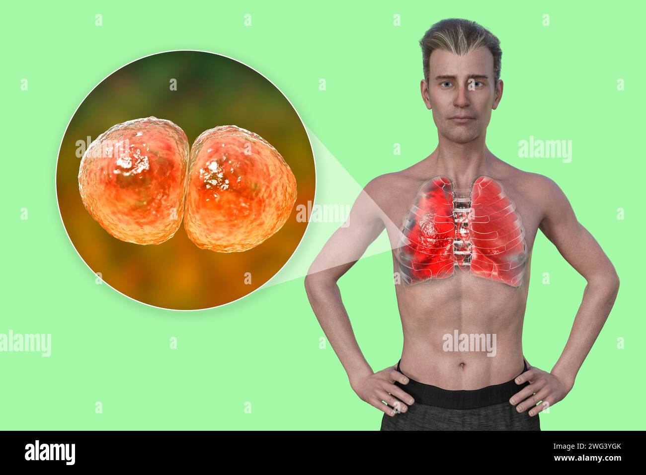 Infection pneumococcus pneumoniae hi-res stock photography and images ...