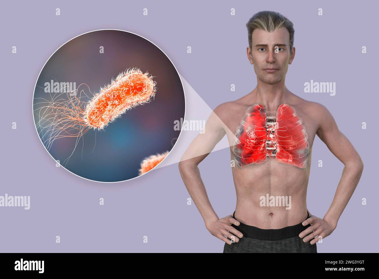 Man with lungs affected by pneumonia hi-res stock photography and ...