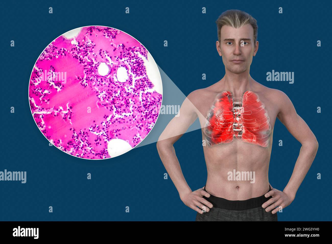 Man with lungs affected by pneumonia, illustration Stock Photo - Alamy