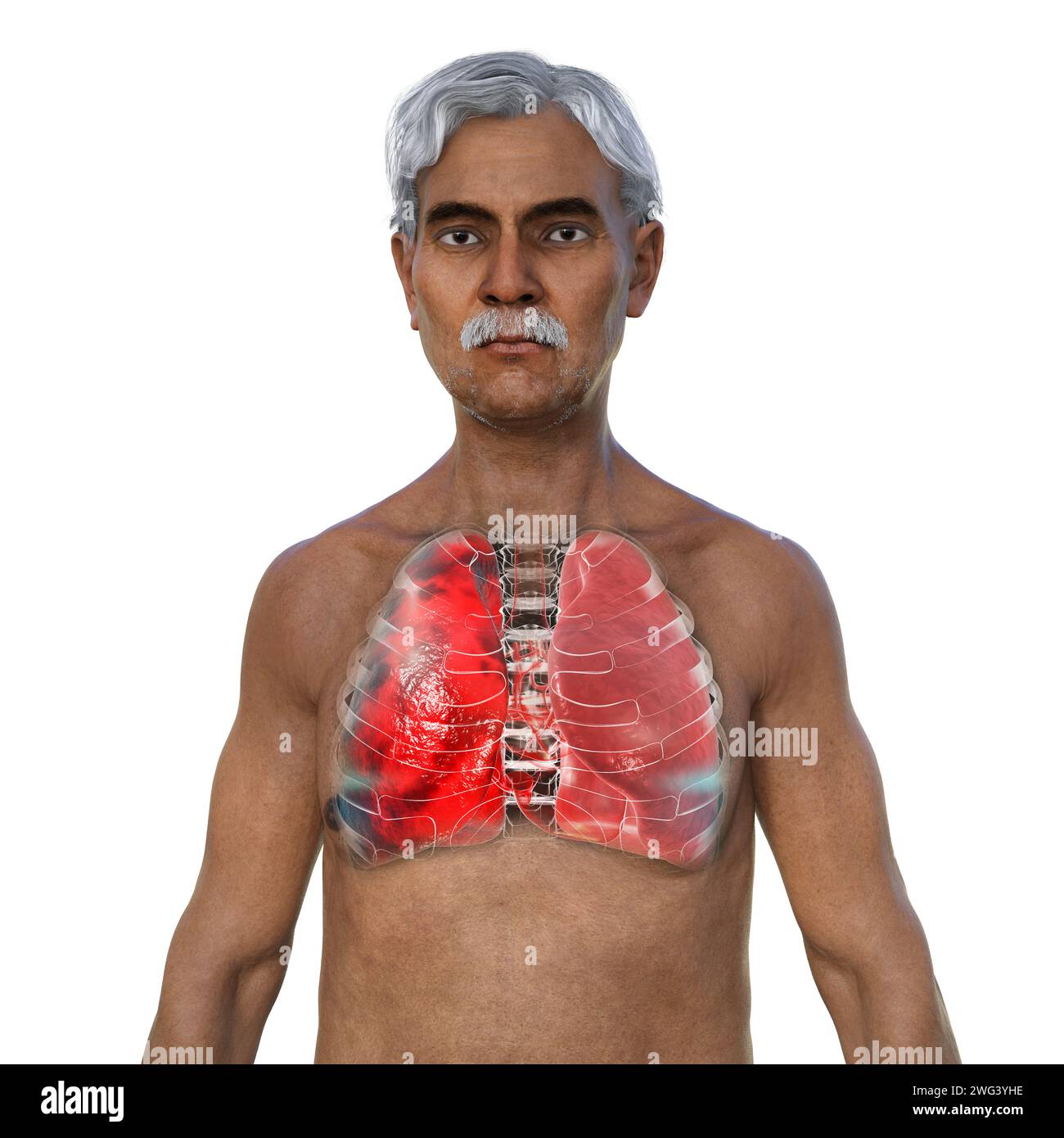 Man with lungs affected by pneumonia, illustration Stock Photo - Alamy
