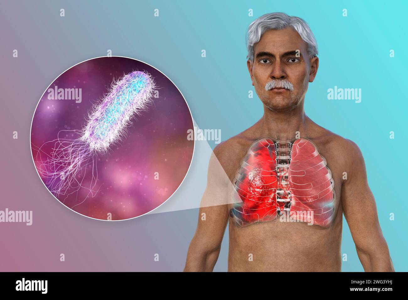 Man with lungs affected by pneumonia, illustration Stock Photo - Alamy