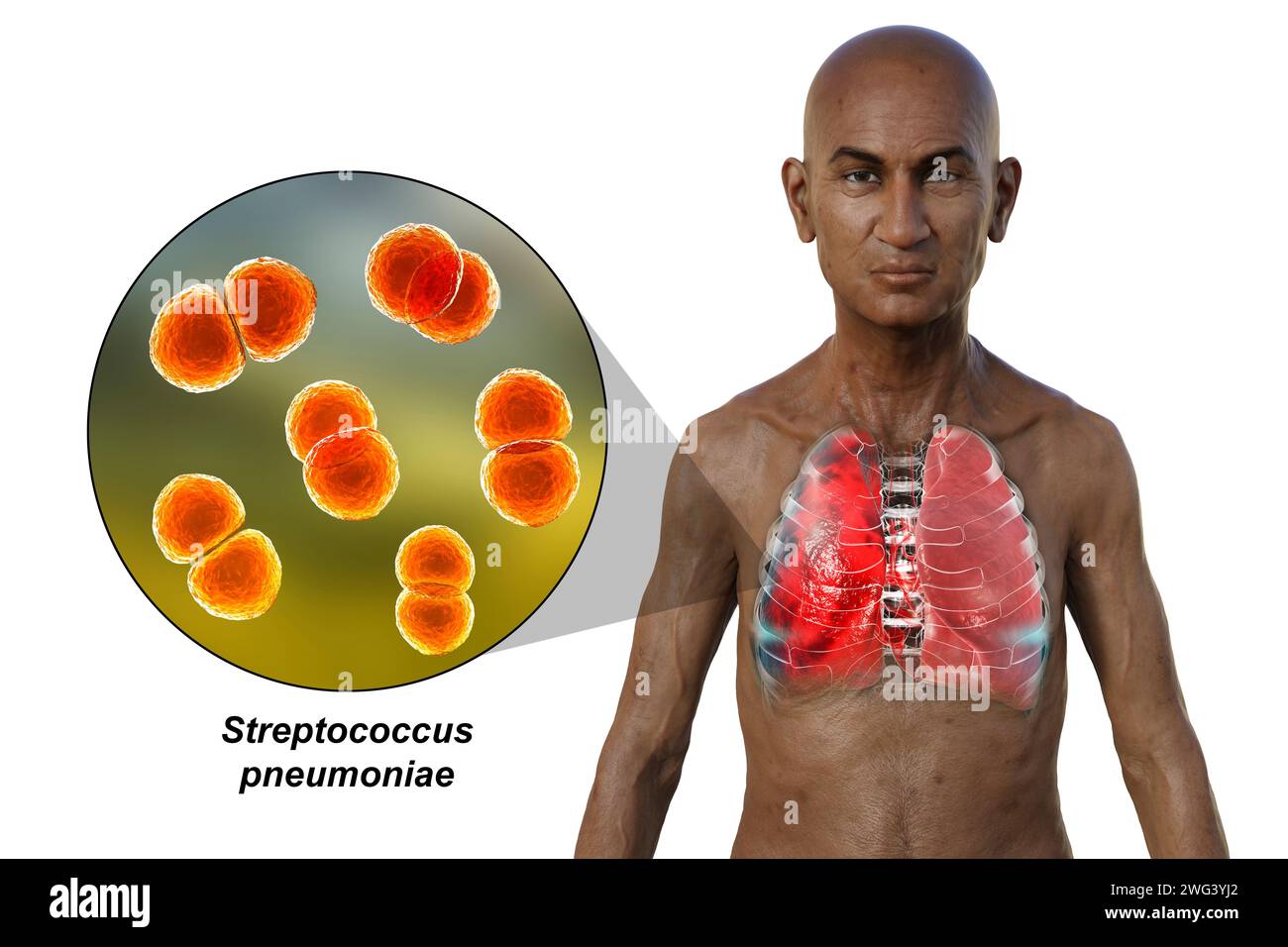Man with lungs affected by pneumonia, illustration Stock Photo - Alamy