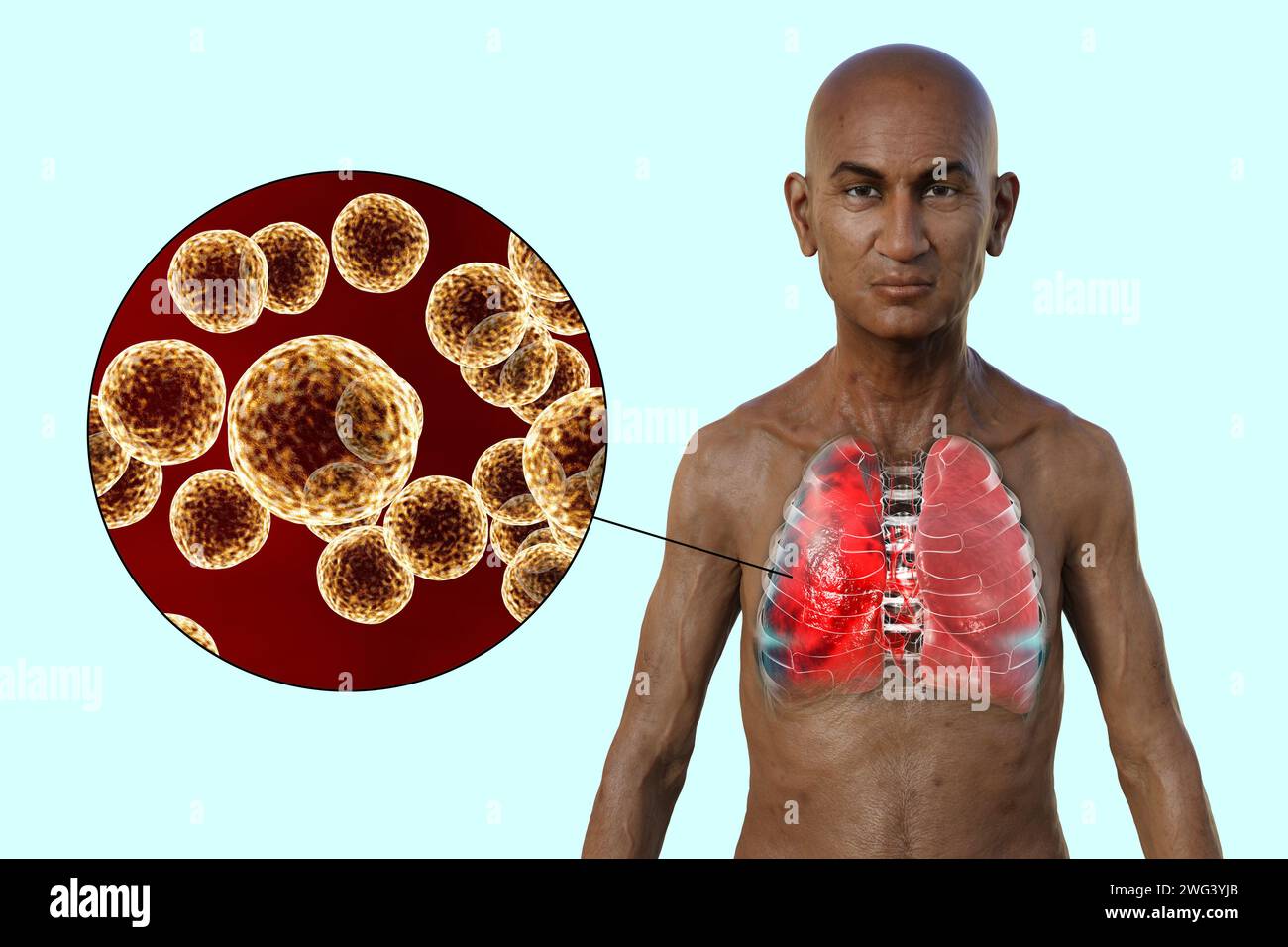 Man with lungs affected by pneumonia, illustration Stock Photo - Alamy