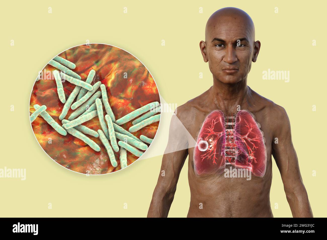 Man with lungs affected by cavernous tuberculosis, illustration Stock ...