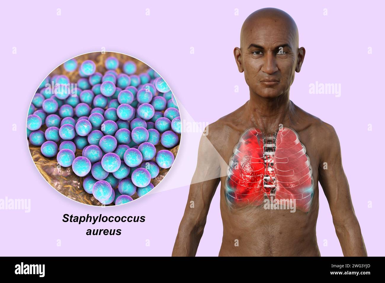 Man with lungs affected by pneumonia, illustration Stock Photo - Alamy