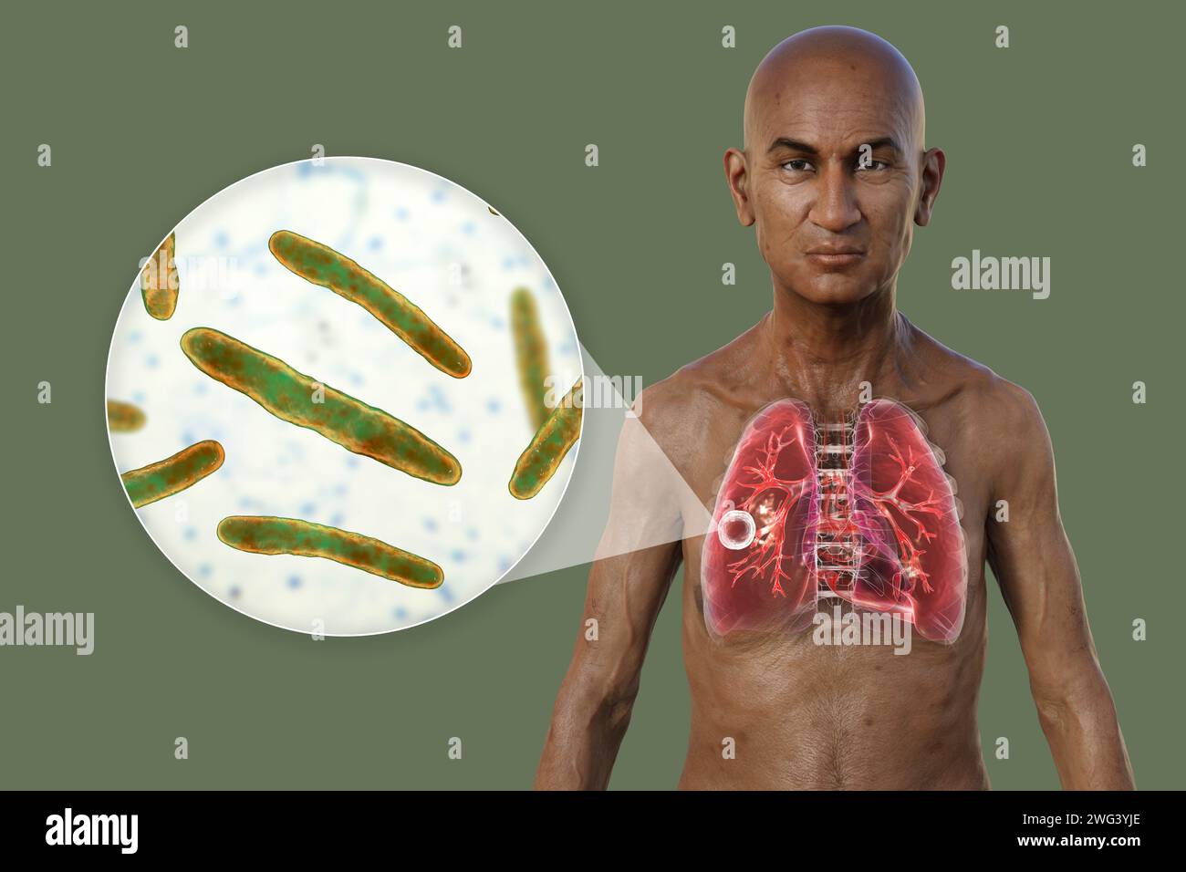 Man with lungs affected by cavernous tuberculosis, illustration Stock ...