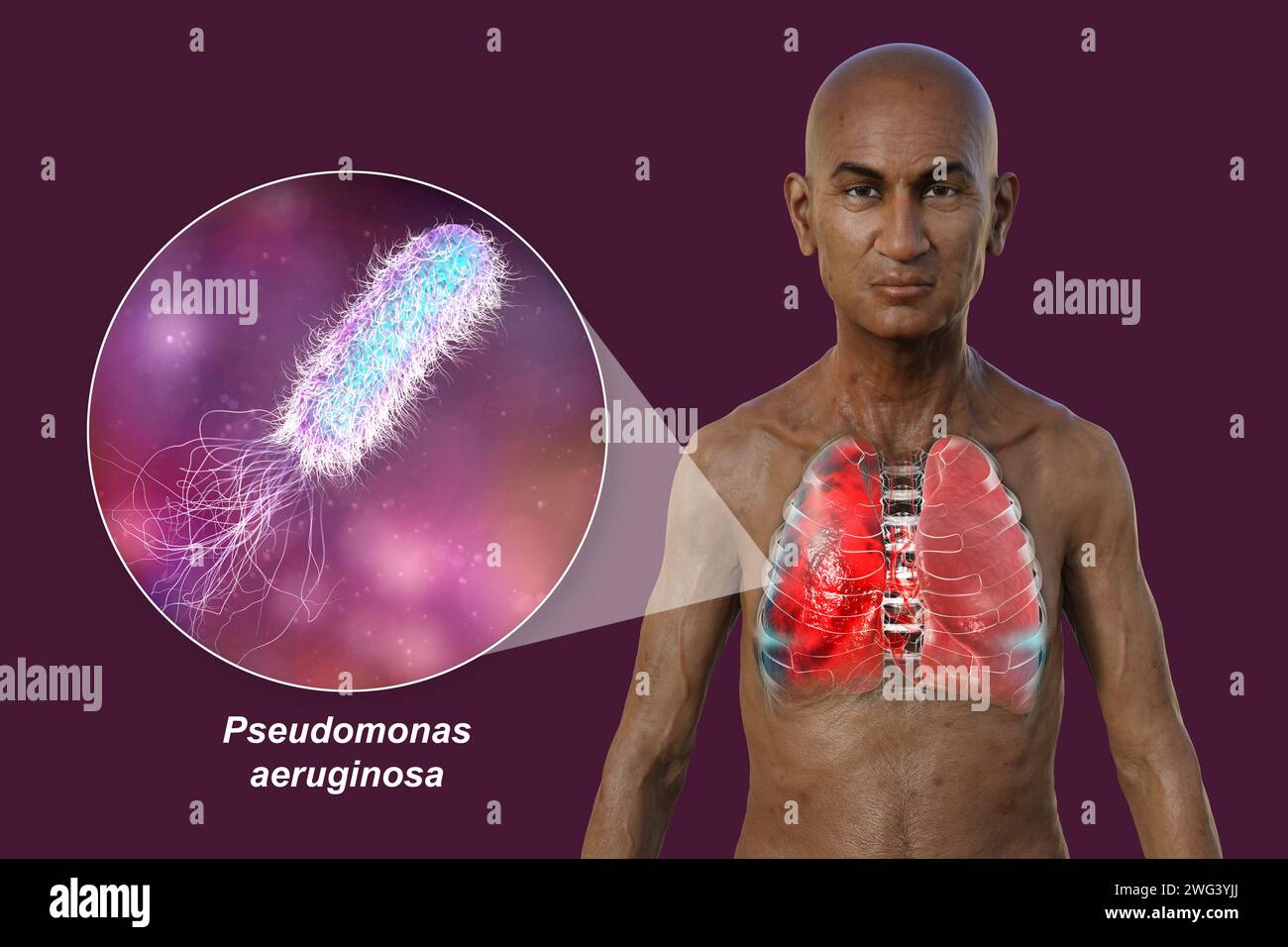 Man with lungs affected by pneumonia, illustration Stock Photo - Alamy