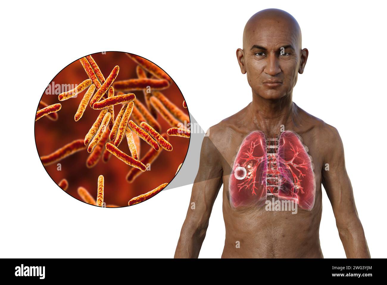 Man with lungs affected by cavernous tuberculosis, illustration Stock ...
