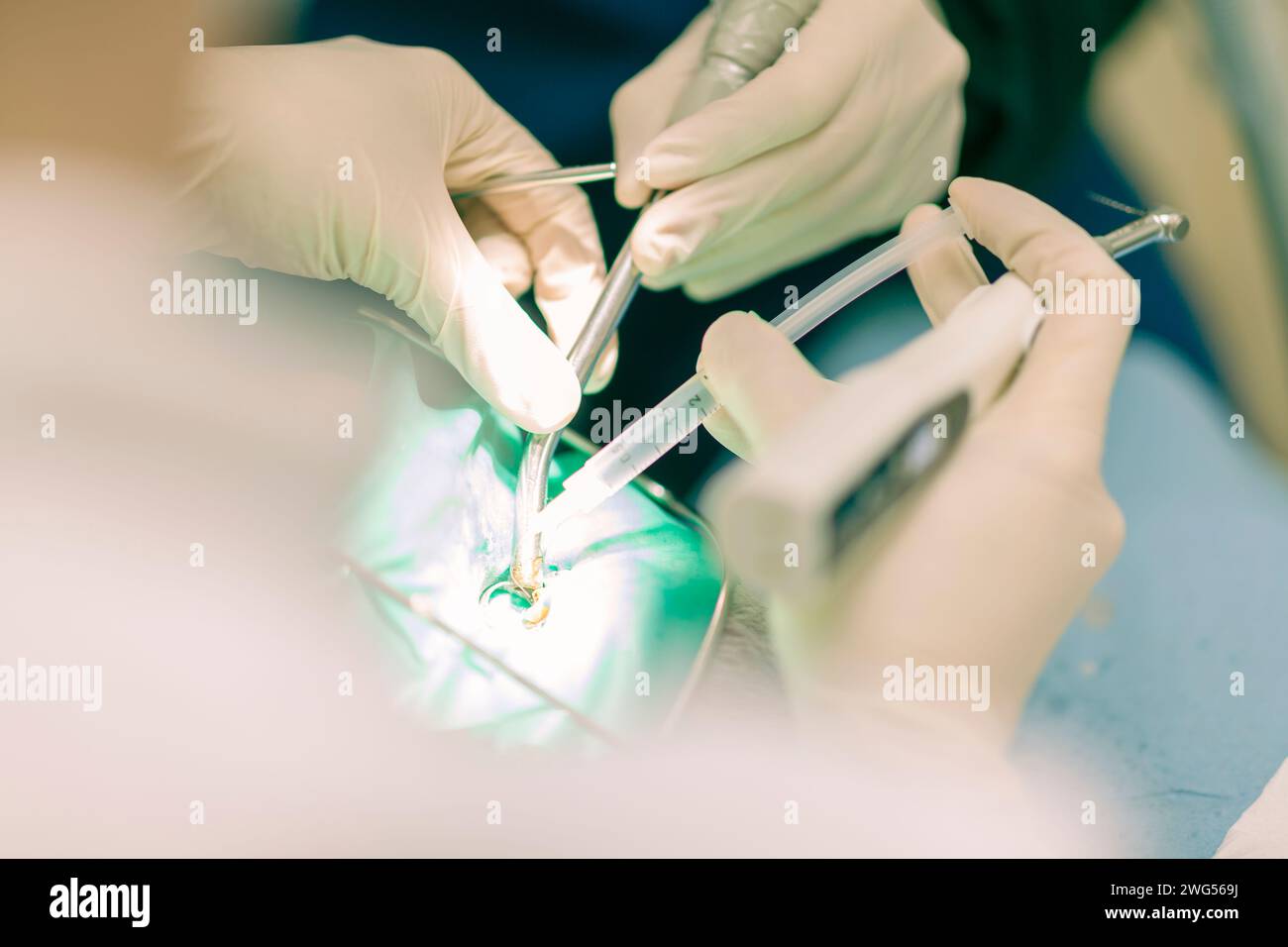 Detail of a dentist performing surgery with anesthesia on a patient for root canal treatment and ...