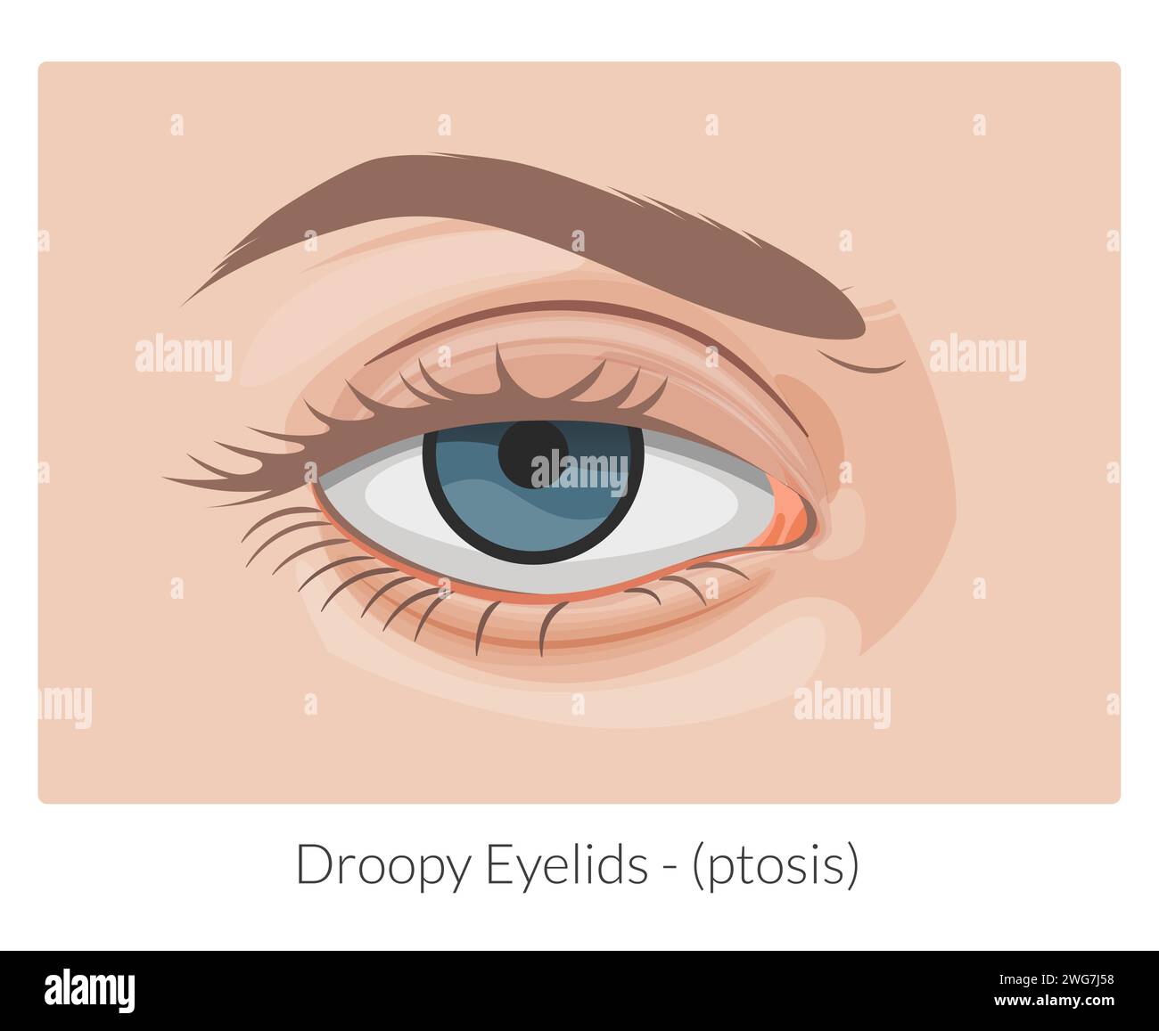 Ptosis drooping upper eyelid - Stock Illustration as EPS 10 File Stock ...