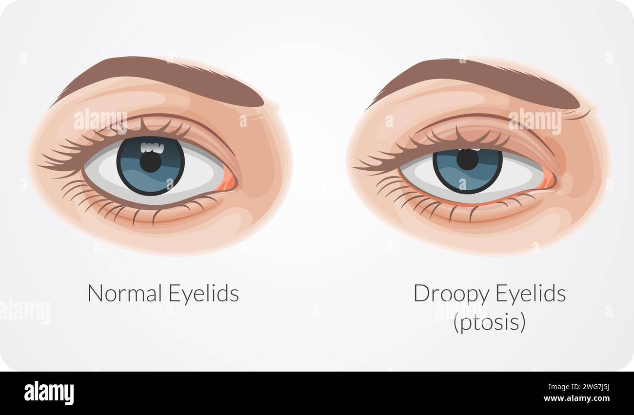 Lower eyelid bags hi-res stock photography and images - Alamy