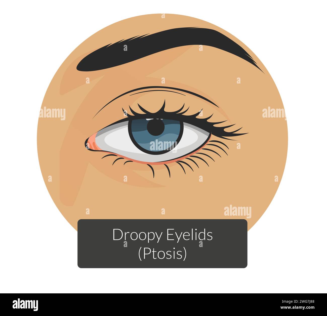 Ptosis drooping upper eyelid - Stock Illustration as EPS 10 File Stock ...