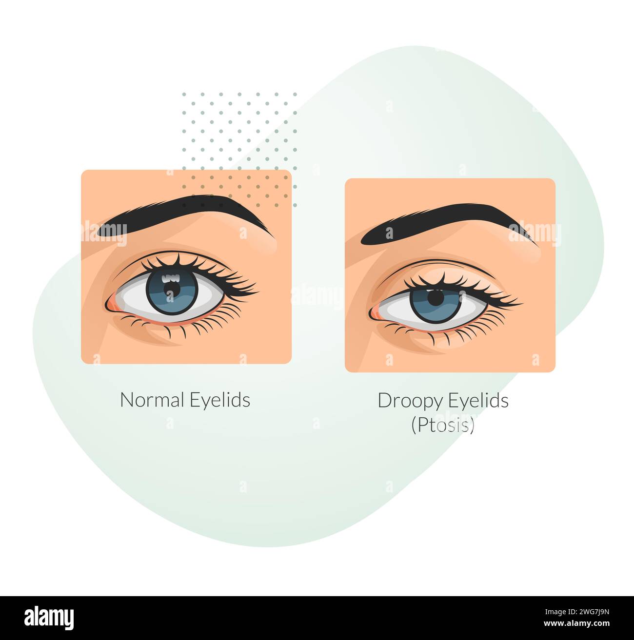 Lower eyelid bags hi-res stock photography and images - Alamy