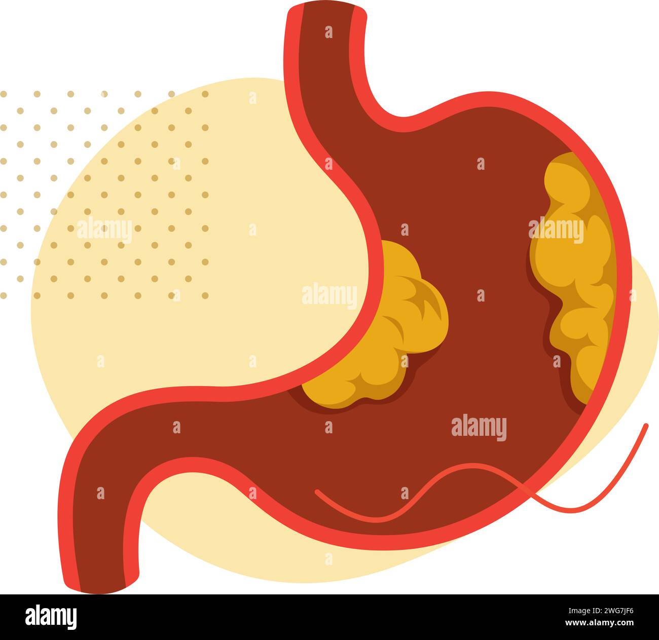Stomach cancer doctor Stock Vector Images - Alamy