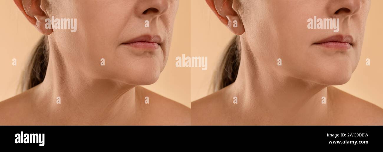 Aging skin changes. Woman showing neck before and after rejuvenation ...